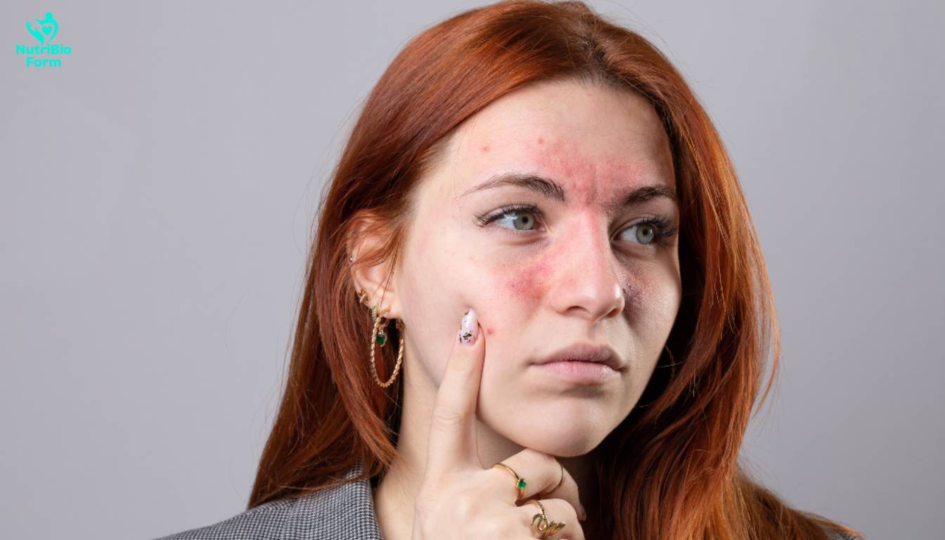 Rosacea: How Can You Soothe the Redness and Treat It Naturally ...